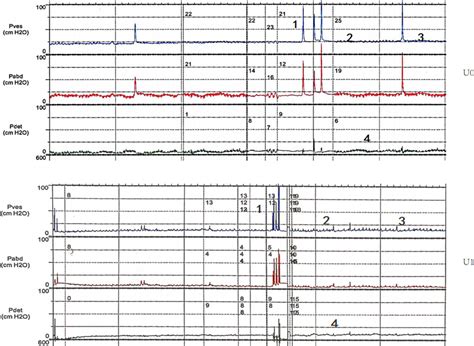 A Specimen Urodynamic Test Was Performed 1 Week Before The Operation Download Scientific