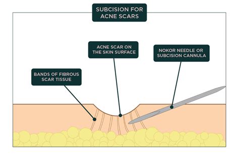 Subcision Sydney Treatment Contour Cosmetic Clinics