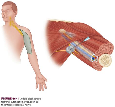 Peripheral Nerve Blocks Block Techniques