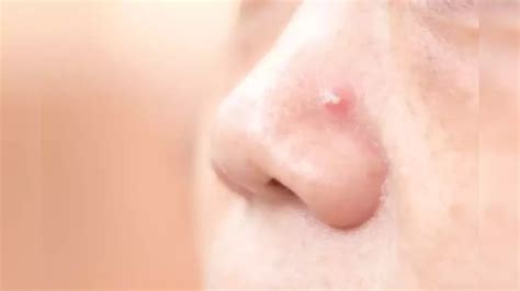Cancer On Nose Causes Symptoms And Treatment Phonemantra