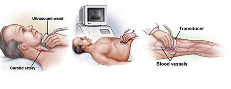 Medical Duplex Scan Duplex Ultrasound Aosa
