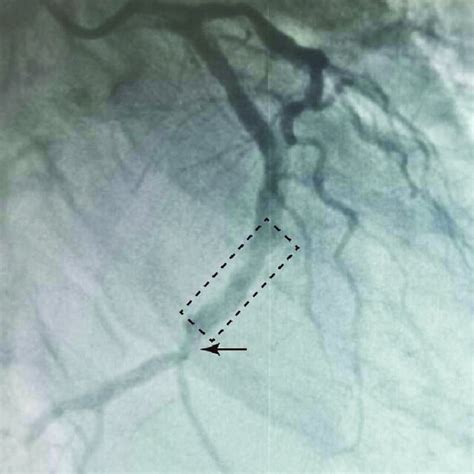 The Image Of Coronary Angiogram Preoperative The Left Circumflex