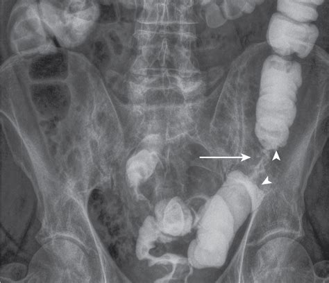 Bowel Wall Thickening Radiology Key