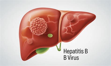 Hepatitis B Causes Symptoms Treatment And Prevention