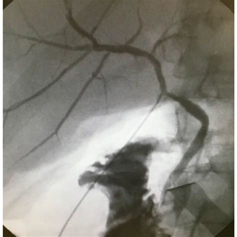 Intraoperative Cholangiogram Through The Cystic Duct Stump Download
