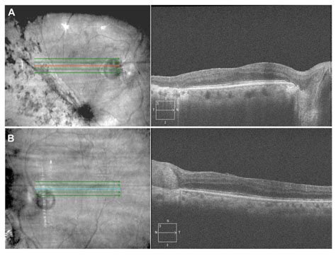 Autosomal Dominant Vitreoretinochoroidopathy With A Novel Best1 Mutation And A Review Of