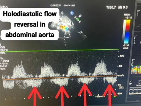 Holodiastolic Flow Reversal In Abdominal Aorta Due To Severe Ar Ahmed Mohsen