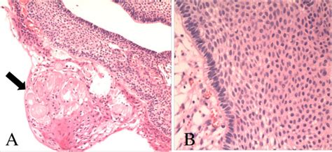 Photomicrographs Of The Pathological Specimen Showing The Features Of