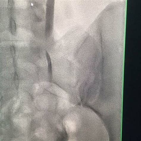 Antegrade Urethrogram Showing Proximal Ureter Opacification With Download Scientific Diagram