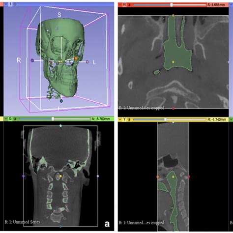 A Example Of Skull And Maxillary Bones Segmentation In 3d Slicer Download Scientific Diagram