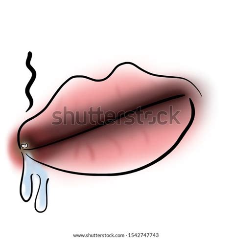 Angular Cheilitis Right Corner Mouth Stock Illustration 1542747743
