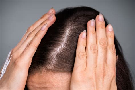 Diffuse Thinning Signs Symptoms And Treatment Options