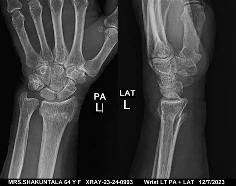 Wrist X Ray Hand Carpal Bone Metacarpal Bone Radiology Image