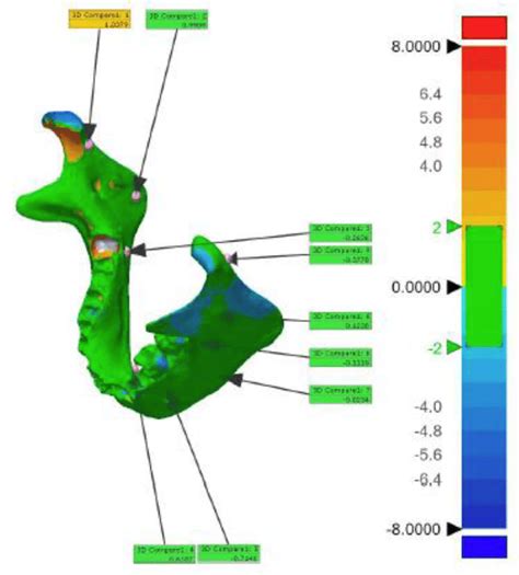 Qualitative Congruency Analysis Performed On Scanned Data Of A