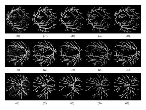 Shows Different Segmentation Results Obtained Through Clahe With