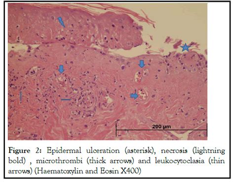 Pyoderma Gangrenosum Mimicking Anti Phospholipid Antibody Syndrom