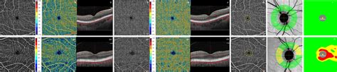 First Row Shows Optical Coherence Tomography Angiography Octa Images
