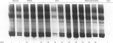 Point Mutations In Cervical Samples Pcr Sscp Analysis Of Dna Of P16 Download Scientific