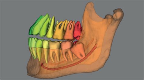 Dental Update The Use Of Artificial Intelligence In Third Molar
