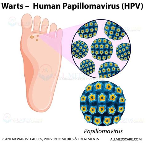Plantar Warts Causes Proven Remedies And Treatments