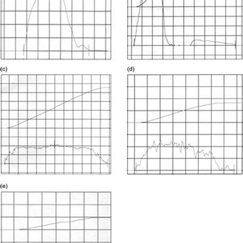 Five Urinary Flow Patterns Shown In The Uroflowmetry The Download Scientific Diagram