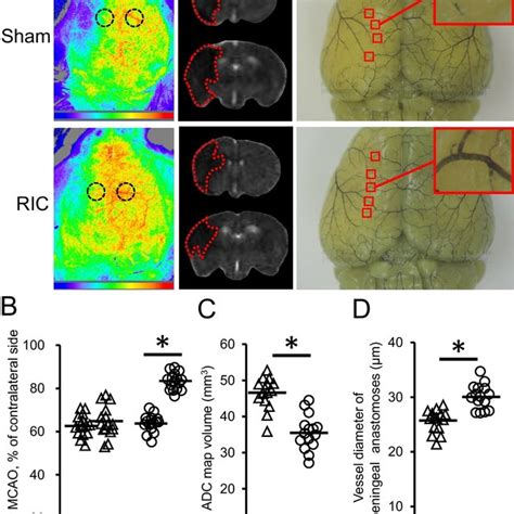 Collateral Circulation Adc Map In Mri Dwi And Leptomeningeal