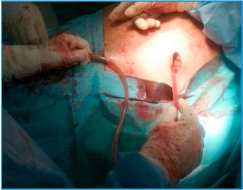 Figure 1 From Retroperitoneal Necrosectomy Using Lavage Circuit As A