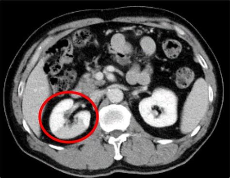 Asymptomatic Idiopathic Renal Infarction Detected Incidentally On
