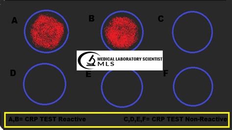 C Reactive Protein Test Principle Procedure Requirements Results And Interpretation