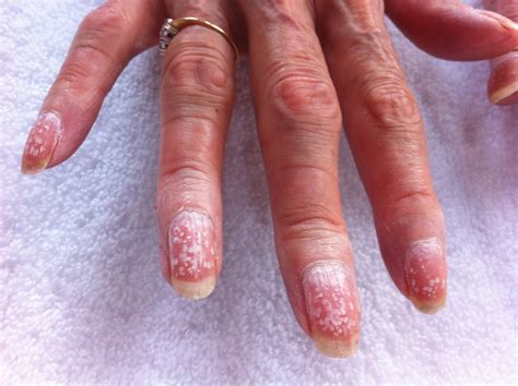 Allergy To Gel Polish 32 Photos Symptoms And Causes List Of