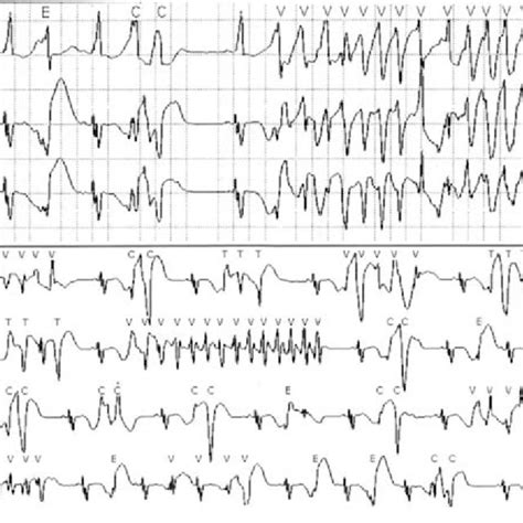 Postoperative ECG Demonstrates Right Bundle Branch Block And A Download Scientific Diagram