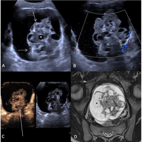 Case 2 10 Year Old Girl With An Immature Teratoma With Potential Download Scientific Diagram