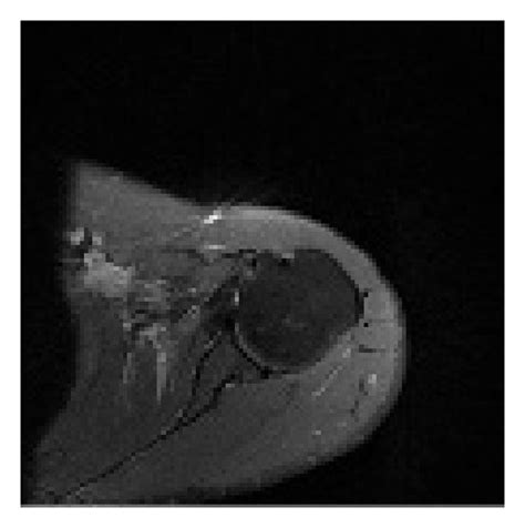 a orginal pd weighted mr image of shoulder b binary segmentation