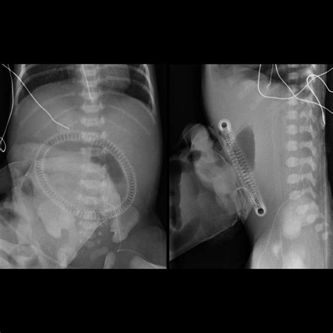 Premature Newborn After Picc Placement Pediatric Radiology Case Pediatric Imaging