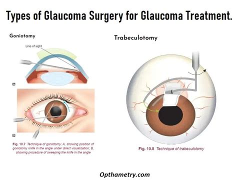 Types Of Glaucoma Surgery For Glaucoma Treatment An Eye Care Blog