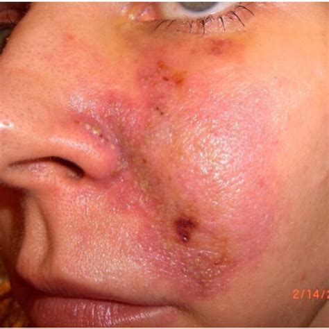 Formation Of Pustules On The Nose And A Full Thickness Defect Near The Download Scientific