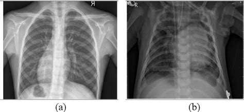 Figure 1 From Automated Pneumonia Detection From Chest X Rays Using Convolutional Neural