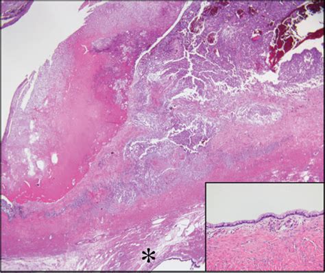 Microcystic Stromal Tumor Mst Of The Ovary A Solid Nodule With