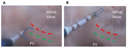 Visualization Of An Innovative Approach For Mitral Isthmus Ablation