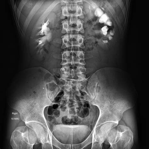Bilateral Ureteropelvic Junction Obstruction Image