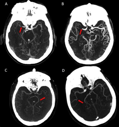Ai Software Detection Of Large Vessel Occlusion Stroke On Ct
