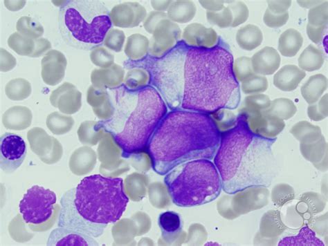 Aml With Mutated Cebpa