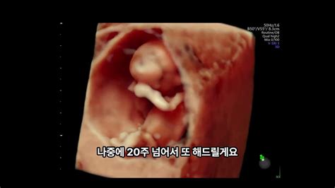 12주차 정밀 초음파 1차 기형아 검사 Youtube
