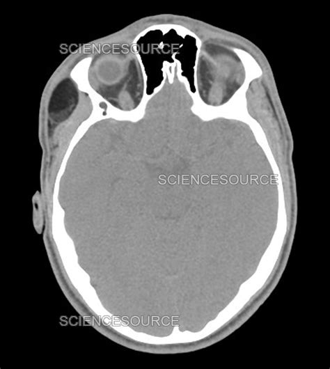 Congenital Dermoid Cyst Ct Scan Stock Image Science Source Images