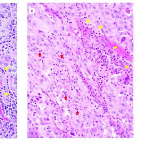 Lymphocytes And Polymorphonuclear Neutrophil Pmn Quantification In Download Scientific
