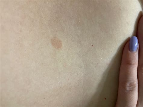 Красные круглые пятна на теле - Вопрос дерматологу - 03 Онлайн