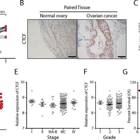 Ctcf Expression Is Upregulated In Metastatic Lesions Of Ovarian Cancer