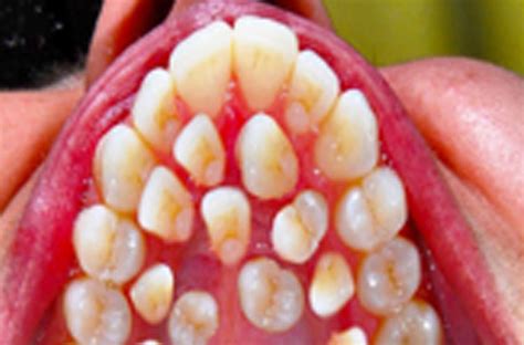 Hyperrdontia