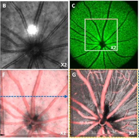 Visualization Of In Vivo Slo Fslo And Tsa Oct Octa Data Acquired Download Scientific Diagram