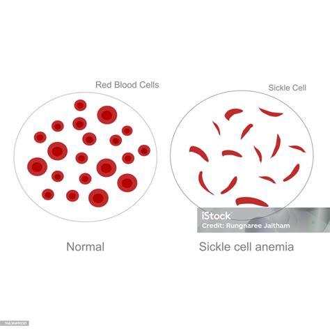 Perbedaan Morfologi Sel Darah Merah Antara Sel Normal Dan Sel Sabit